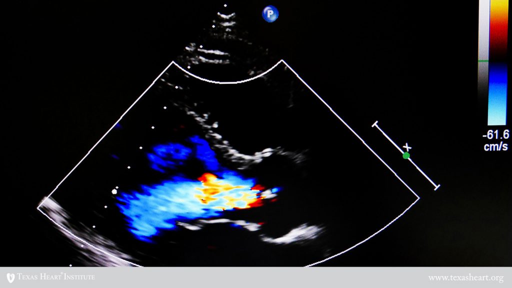 What does 45% mean in an echo report? | The Texas Heart Institute®