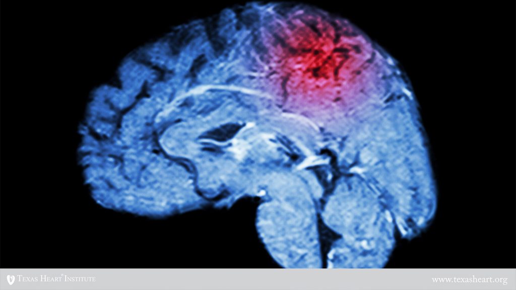 Para prevenir el accidente cerebrovascular, controle todos los factores ...