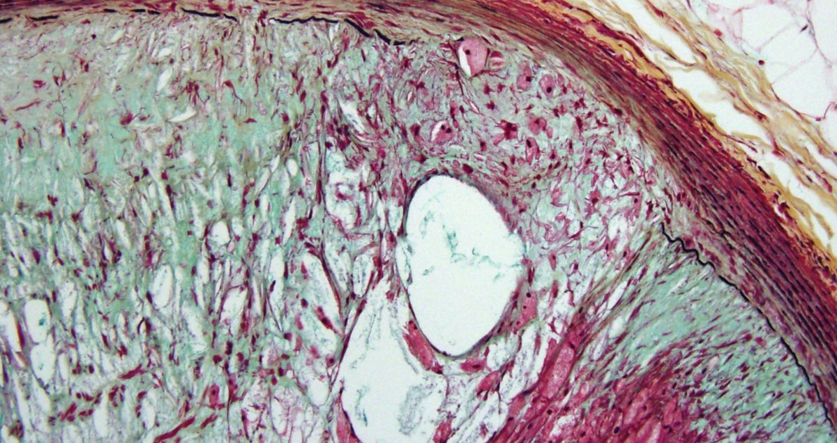 Cardiovascular Pathology | The Texas Heart Institute®