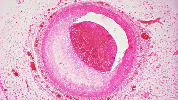 Study Shows Selection of Coronary Stenting versus Bypass Surgery for ...