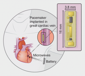 Texas team debuts battery-less pacemaker | Texas Heart Institute