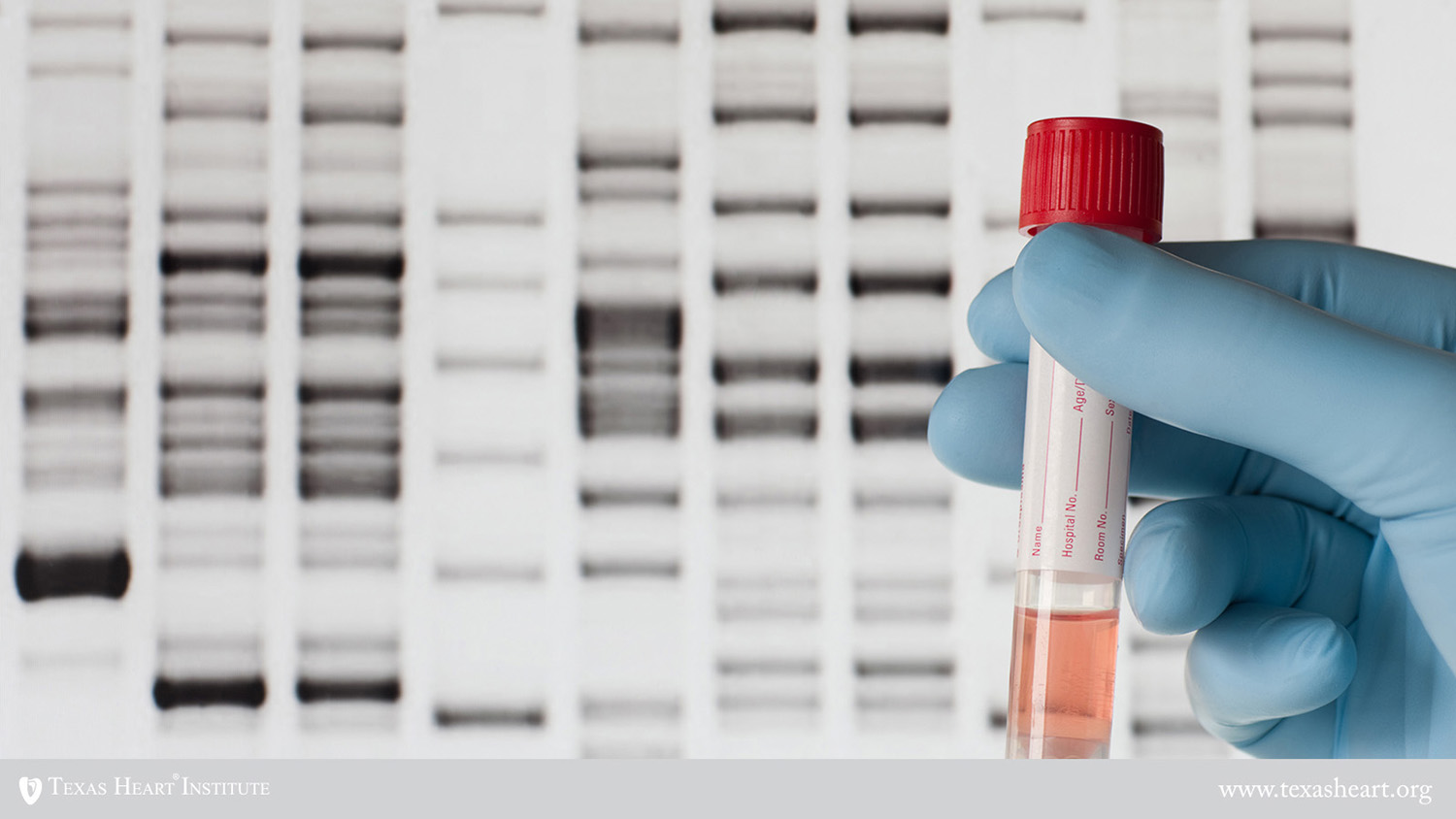 Fibromuscular Dysplasia (FMD): The Rare Disease That Isn’t | The Texas ...