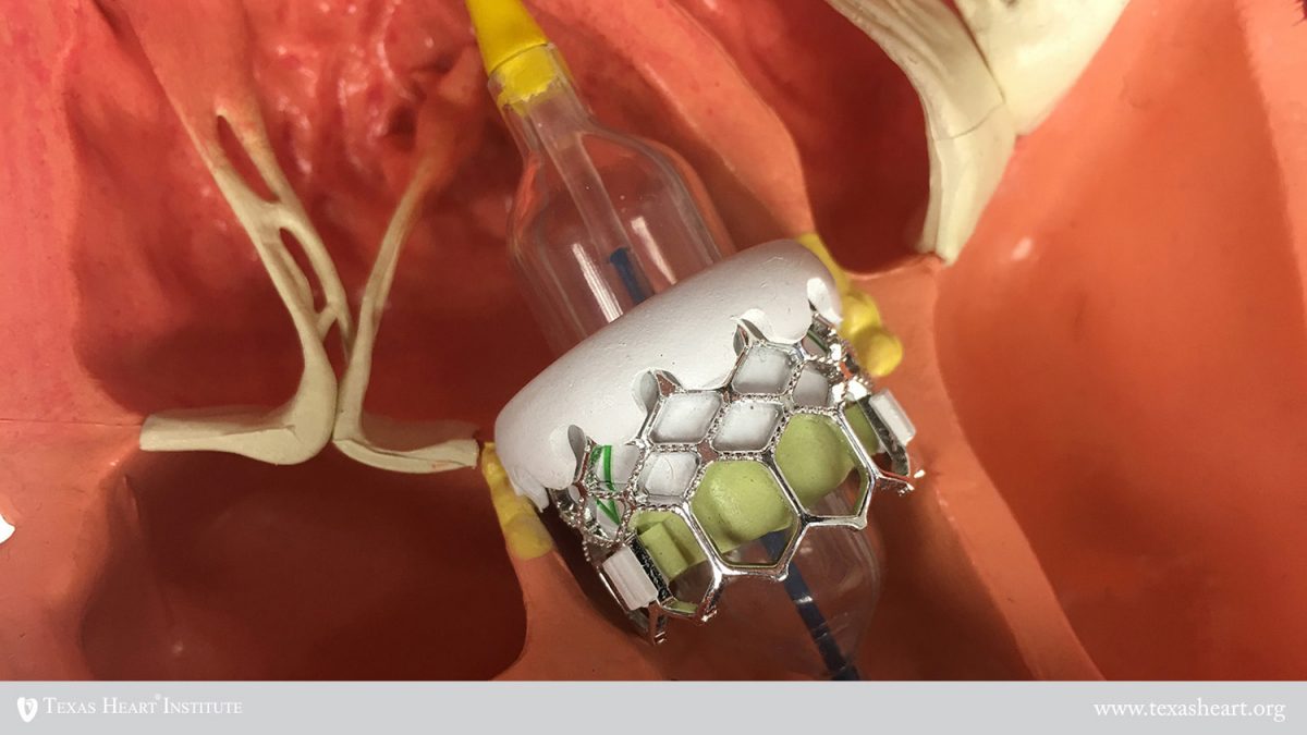 Aortic Valve Tavr Procedure Aortic Valve Tavr Procedure