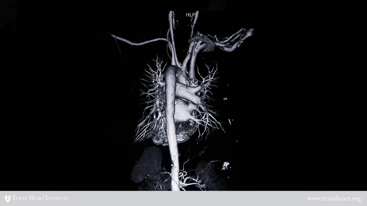 Thirty Years of Experience with the “Elephant Trunk” Technique | The ...