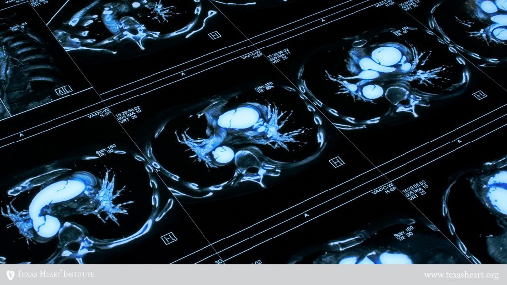 Types of Angina | The Texas Heart Institute®