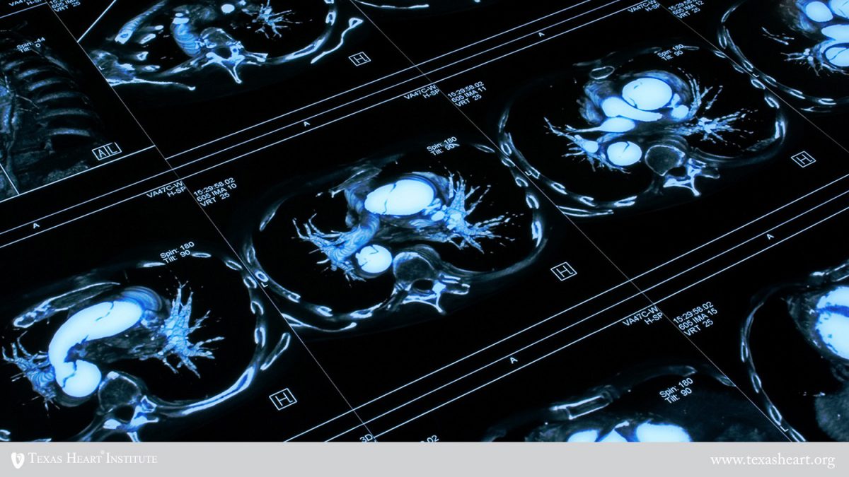 Endocarditis infecciosa | The Texas Heart Institute®