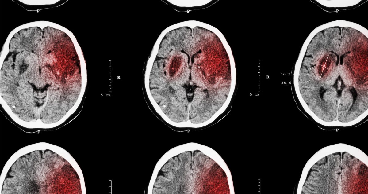 Stroke (iskemik dan hemoragik) | Institut Jantung Texas®