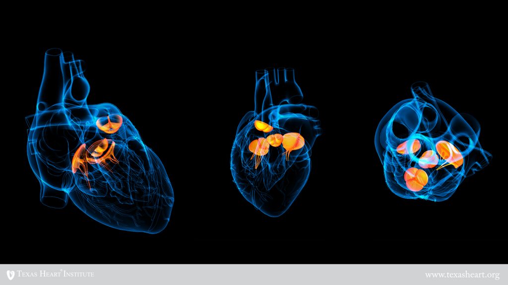 Diseases of the Mitral Valve | The Texas Heart Institute® Diseases of the Mitral Valve | The Texas Heart Institute®