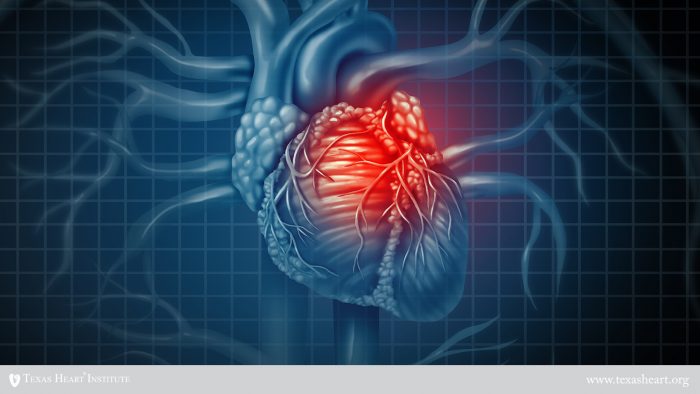 Types of Cardiomyopathy | The Texas Heart Institute®