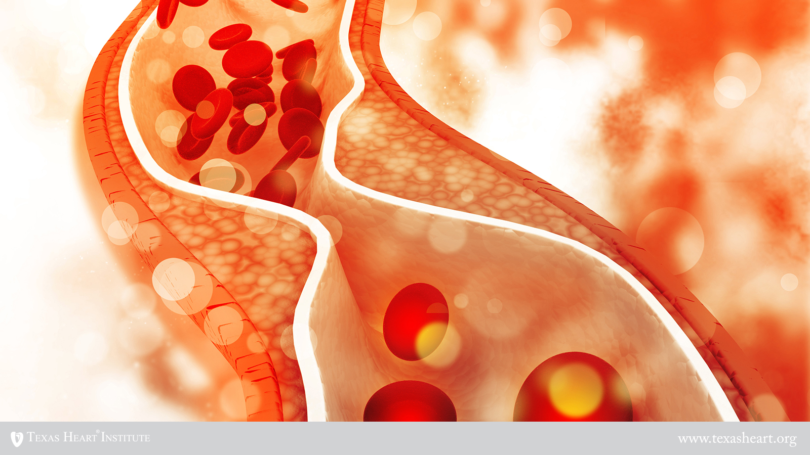 Peripheral Vascular Disease | Texas Heart Institute