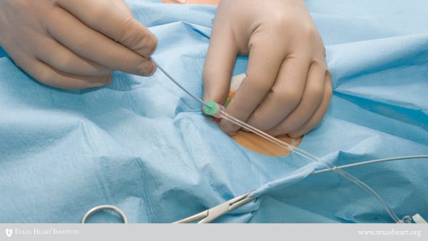 Carotid Artery Angioplasty and Stents | The Texas Heart Institute®