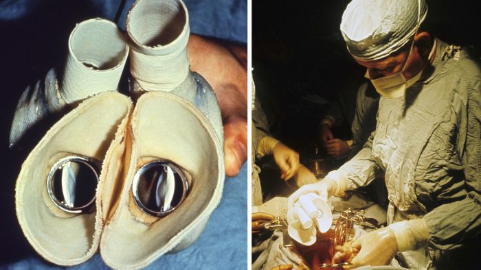 Smithsonian Magazine Highlights the History of the Total Artificial ...