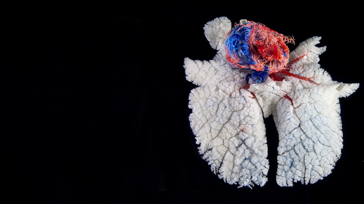 Avoiding Primary Graft Dysfunction After Lung Transplant | The Texas ...