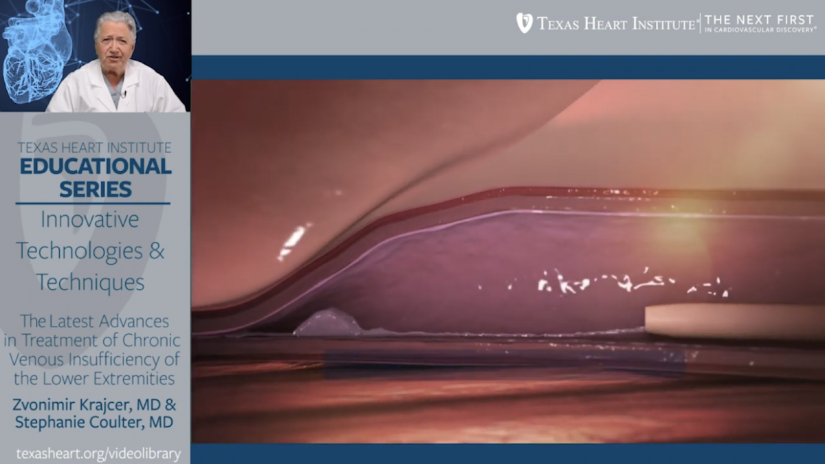 Catheter Ablation Procedure for Treating Atrial Fibrillation (A-Fib ...
