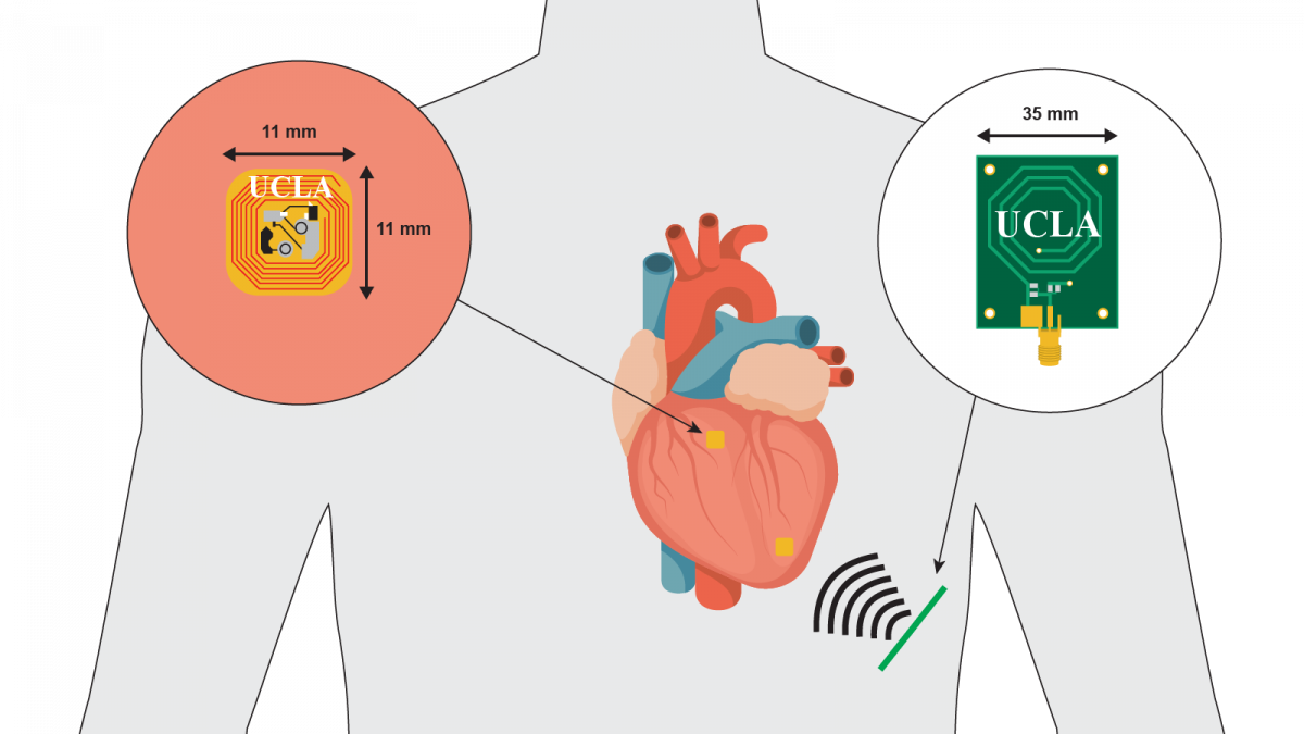 Doctors successfully synchronize both sides of the heart with promising ...
