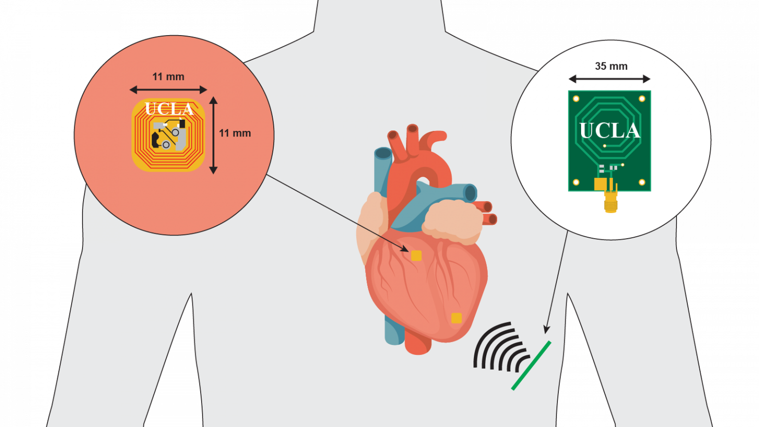 Doctors successfully synchronize both sides of the heart with promising ...