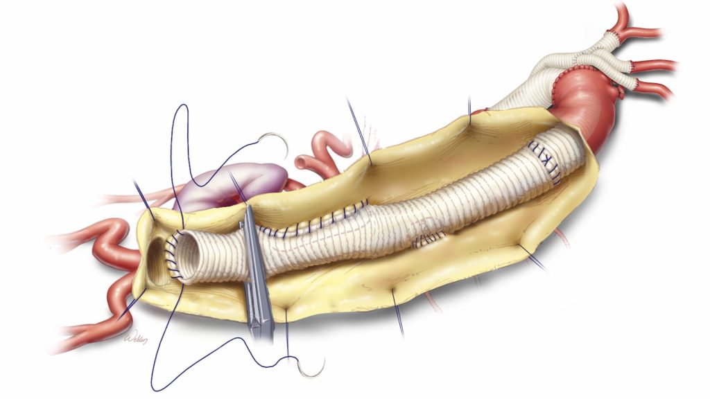 Thirty Years of Experience with the “Elephant Trunk” Technique | The ...