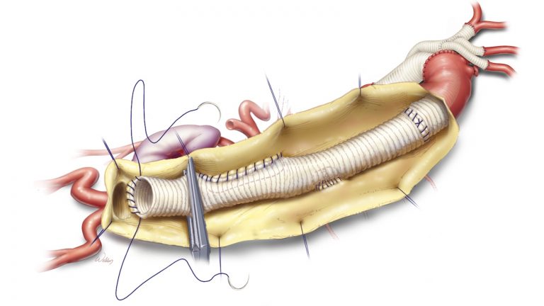 Thirty Years of Experience with the “Elephant Trunk” Technique | The ...