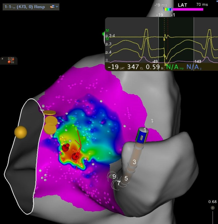New Method of Mapping Electrical Signals in the Heart Could Improve ...