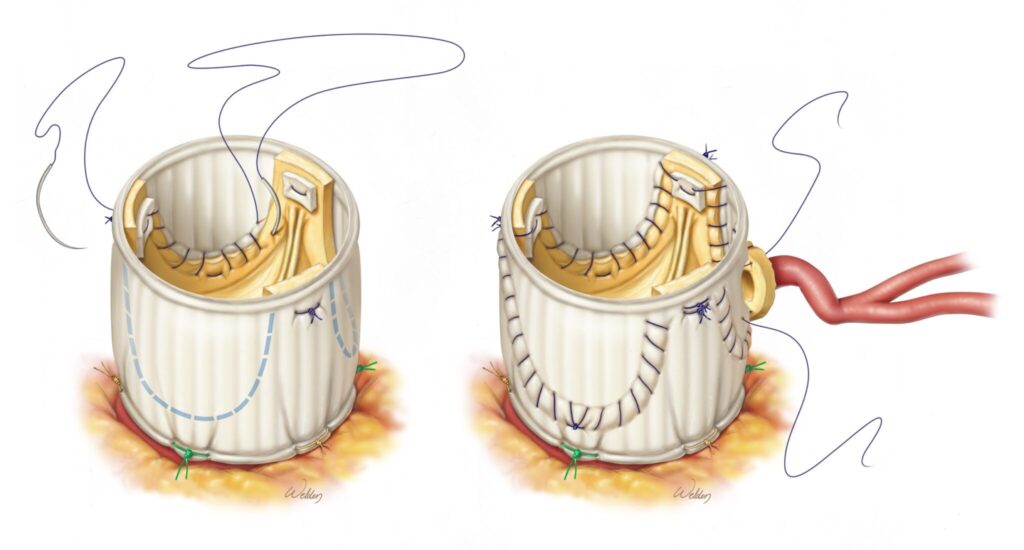 Aneurysms and Dissections | The Texas Heart Institute®