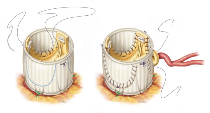Technique for Replacing Aortic Root While Leaving Valve in Place ...