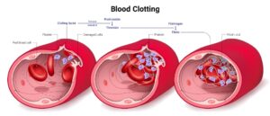 Do I have sticky blood? | The Texas Heart Institute®
