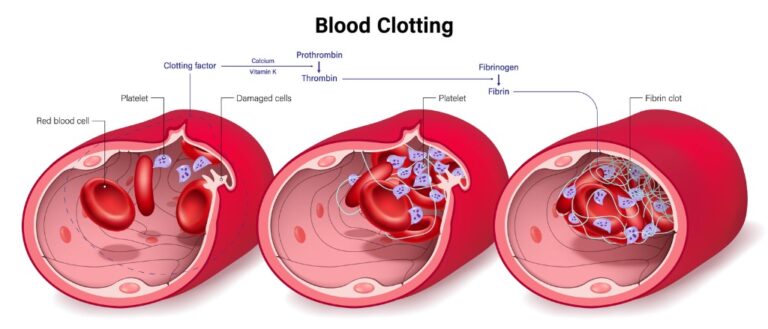 Do I have sticky blood? | The Texas Heart Institute®